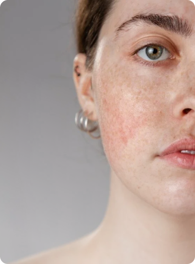 Hyperpigmentation Treatment | Rosacea | Melasma | Mega Aid