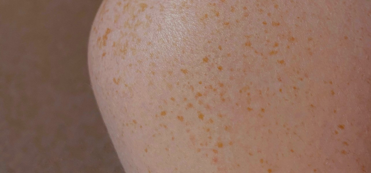 Hyperpigmentation Treatment | Rosacea | Melasma | Mega Aid